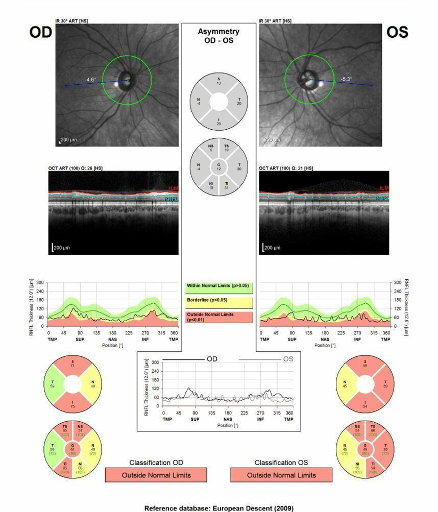 How is the diagnosis of glaucoma established and how is the disease ...