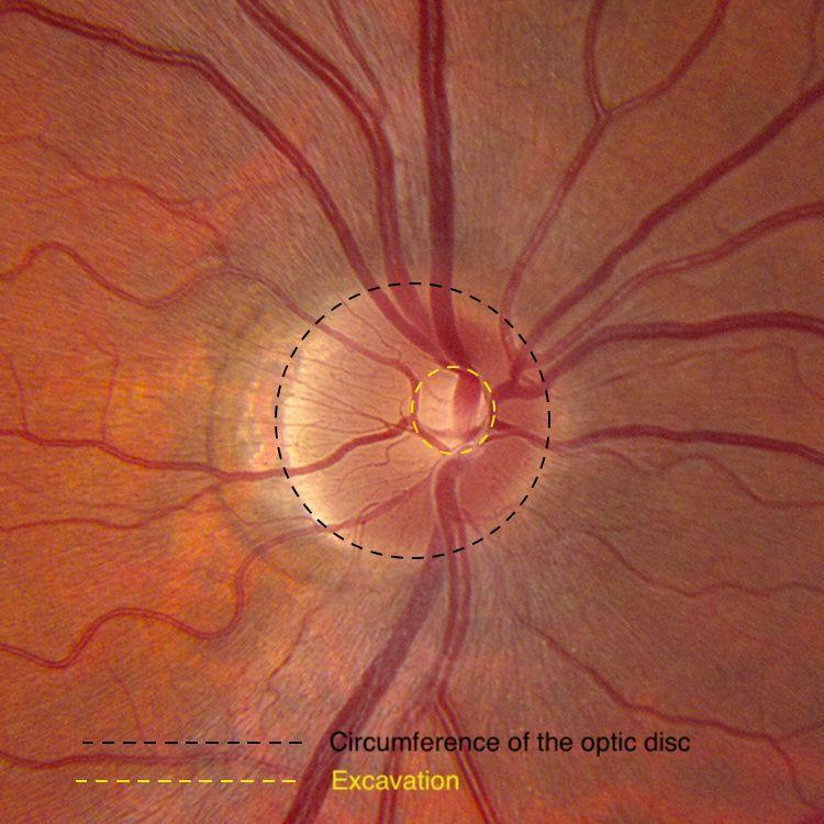 How is the diagnosis of glaucoma established and how is the disease ...